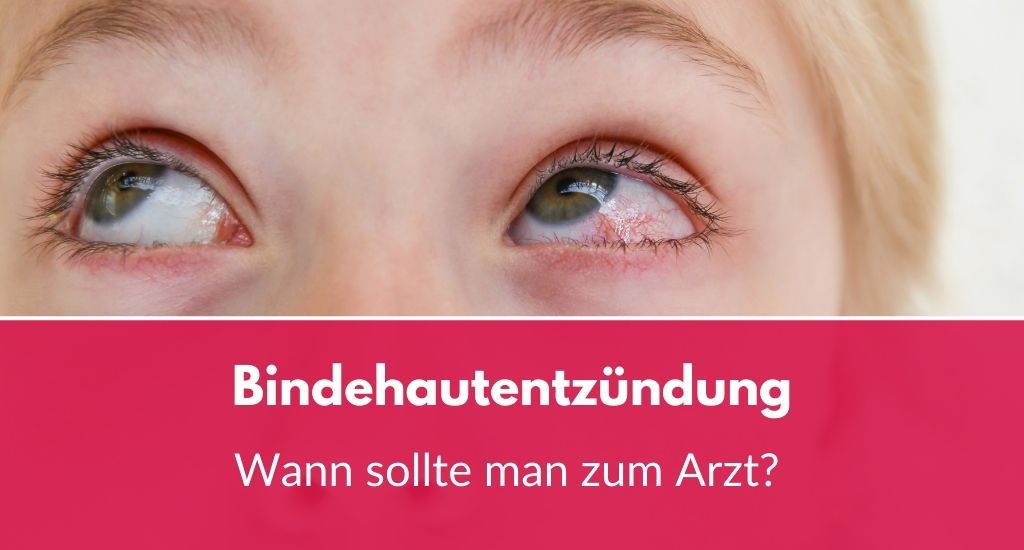 Bindehautentzündung: Wann sollte man zum Arzt?